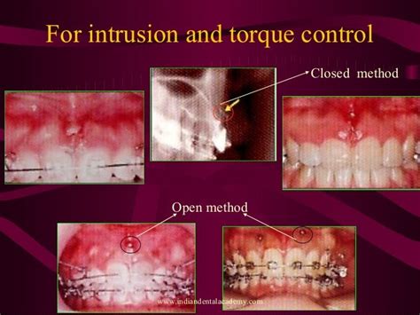 Class 2 Div 2 Malocclusion