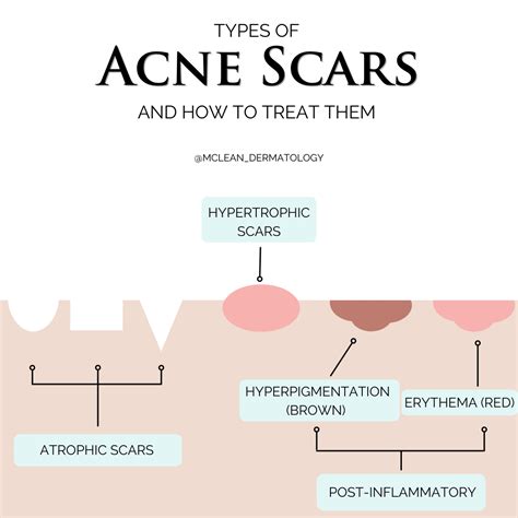 Types Of Acne Scars And How To Treat Them Artofit