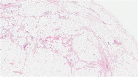 Spindle Cell Lipoma Atlas Of Pathology