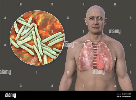 Illustration Of A Man With Lungs Affected By Secondary Tuberculosis And