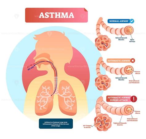 Airway Inflammation Progression In Asthma Shows Normal To Attack Stages