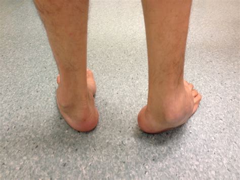 Foot Deformities Singapore Surgery Reconstruction Correction