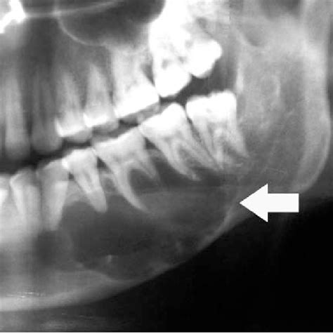 Primordial Odontogenic Tumor A Cropped Panoramic Radi