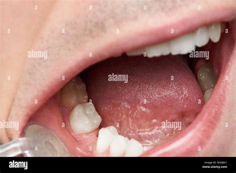Missing Teeth Man Hi Res Stock Photography And Images Alamy
