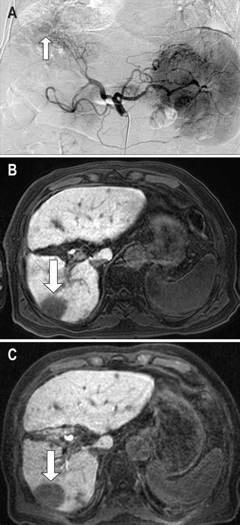 Case 3 An 83 Year Old Man With Unresectable Hepatocellular Carcinoma Download Scientific