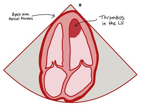 Left Ventricular Thrombus — When The Beat Drops A Residents Guide To