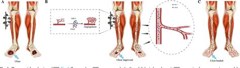 Figure 1 From Efficacy And Safety Of Unilateral Tibial Cortex
