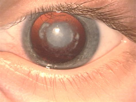 Acquired Cataract Classificationetiopathogenesisand Types Of