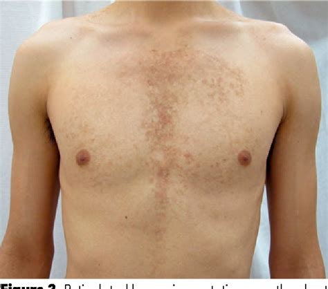 Hyperpigmentation On Back