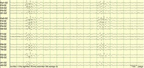 Poly Spike And Wave