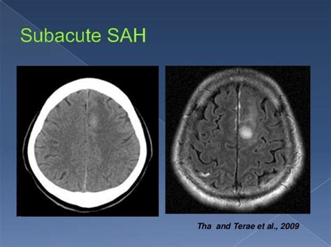 Increased Signal Intensity Of Subarachnoid Space On Flair Mri