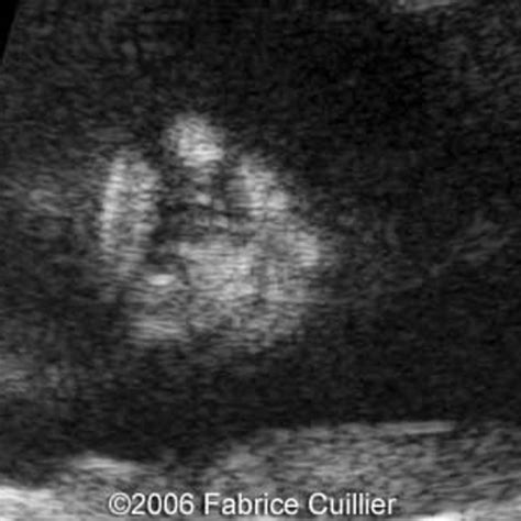 📃 Unilateral Cleft Lip