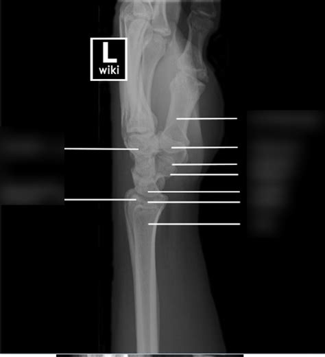 Lateral Wrist Diagram Quizlet