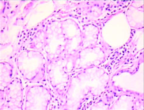 A Focus Of At Least 50 Mononuclear Inflammatory Cells Predominantly Of