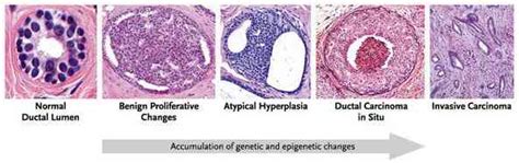 Nejm Ductal Carcinoma In Situ Of The Breast