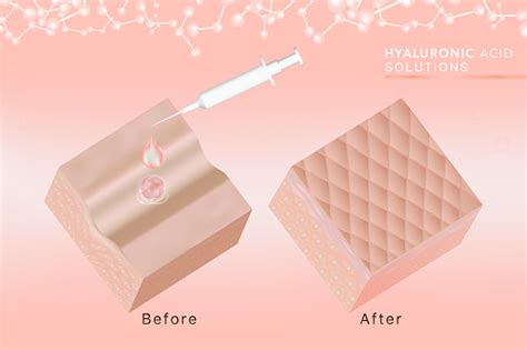 히 알루 론 산 전후 피부 솔루션 광고 핑크 콜라겐 세럼 드롭 화장품 광고 배경 사용 준비 3d 그림에서 주사기 메이크업