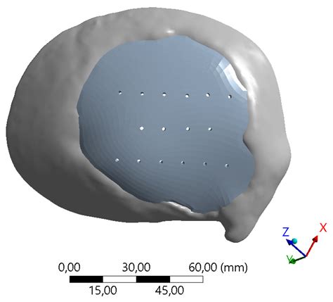 Designs Free Full Text Finite Element Analysis Of Patient Specific