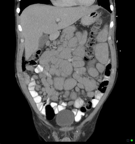 Swollen Lymph Nodes Under Jaw Victoriajulu