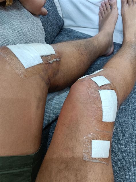 Day 10 Post Op Hamstring Graft Racl