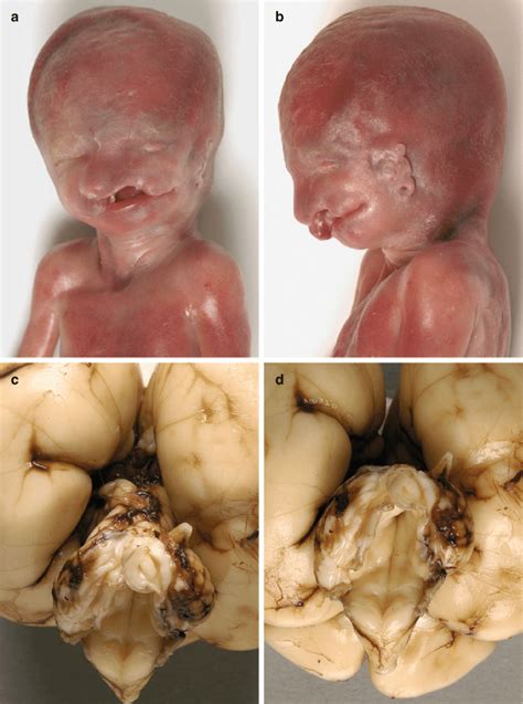 34 Dandy Walker Malformation In A Fetus A B Frontal And Lateral