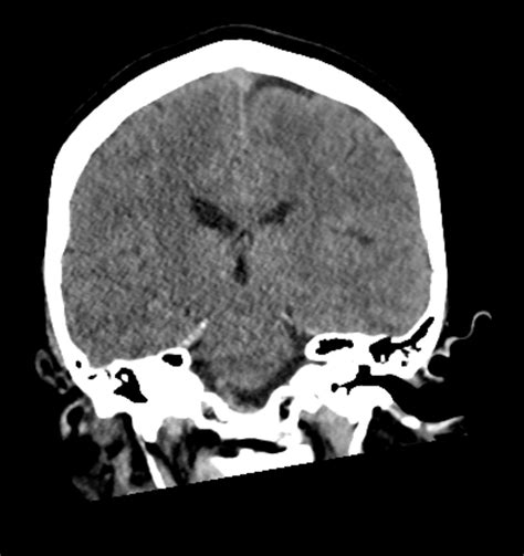 Tentorial Subdural Hematoma Radiology Case