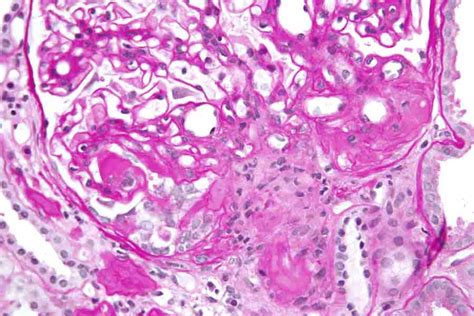 What Is Focal Segmental Glomerulosclerosis Klarity Health Library