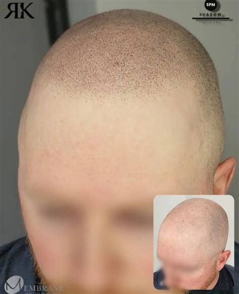 Mens Scalp Micropigmentation Ryan Kingsbury