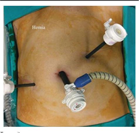 Figure 1 From Impact Of Mesh Fixation Vs Non Fixation In Laparoscopic