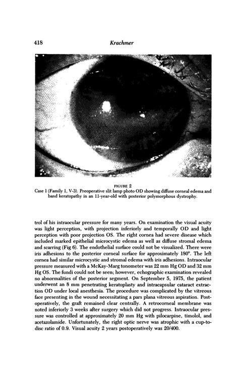 Posterior Polymorphous Corneal Dystrophy A Disease Characterized By