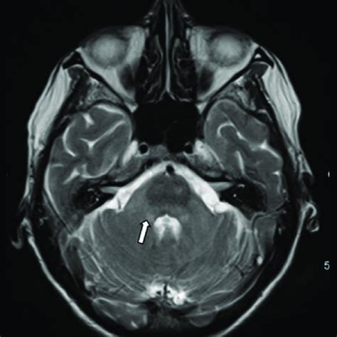 Csf Meningitisencephalitis Pcr Panel Download Scientific Diagram
