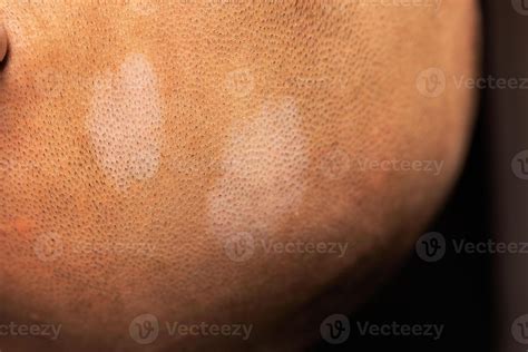 Hypomelanotic Macule On The Scalp In Tuberous Sclerosis 45930341 Stock