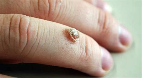Elimina Verrugas Mezquinos Y Callos De Forma Inmediata 36900 En