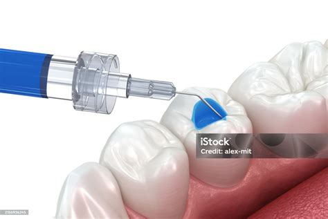 Phosphoric Acidselective Enamel Etching Of The Tooth Medically Accurate