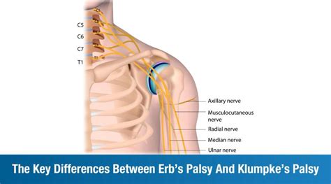 Erbs Palsy Vs Klumpkes Palsy An Overview Plexus