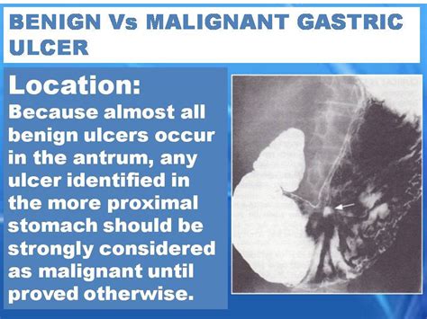 Benign Vs Malignant Gastric Ulcer Radiology Classroom