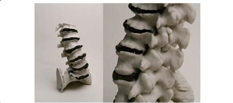 3d Printed Model Of A Lumbosacral Spine With Realistic Spondylosis
