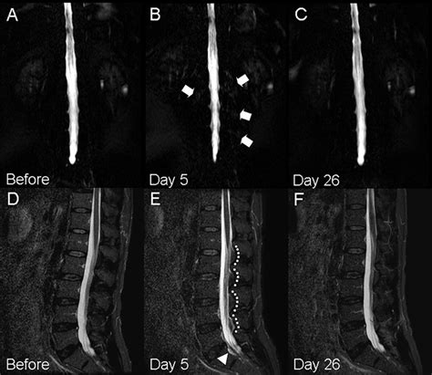 Spinal Tap Test Verseapo