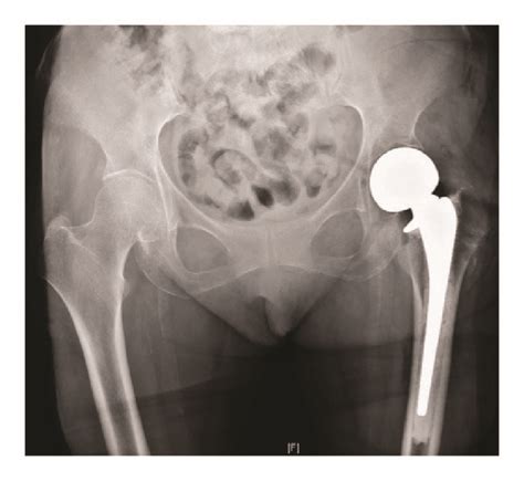 A A 61 Year Old Female Sustained A Syncopal Fall At Home Resulting In