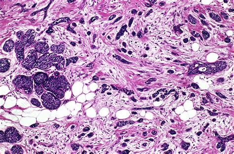 Breast Cancer Light Micrograph Stock Image C0067295 Science