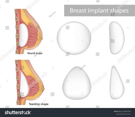 Subglandular Implants Images Stock Photos Vectors Shutterstock