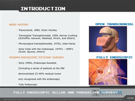 Ppt Advanced Endoscopic Skull Base Surgery Techniques Powerpoint