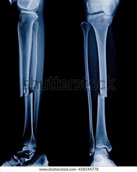 Types Bone Fractures Stock Photos Images Photography Shutterstock