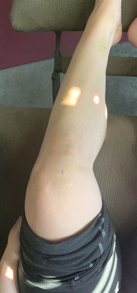 Thursday Makes 3 Weeks Since My Hamstring Graft And I Am Very Happy