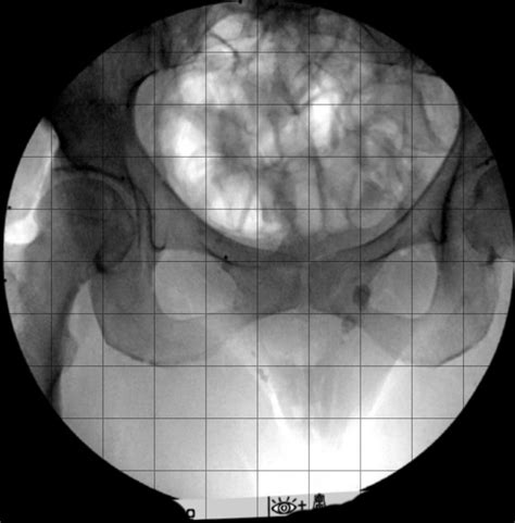 Advanced Fluoroscopic Grid Technology Designed For Orthopaedic Surgery