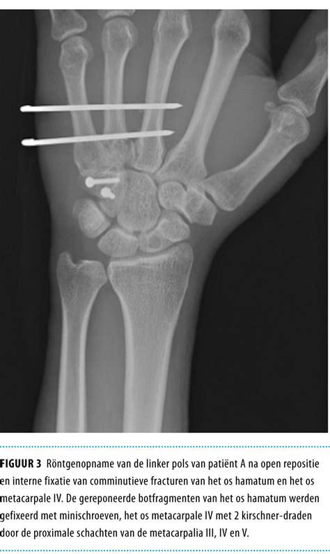 Fractuur Van Een Os Hamatum En Een Os Metacarpale Ntvg