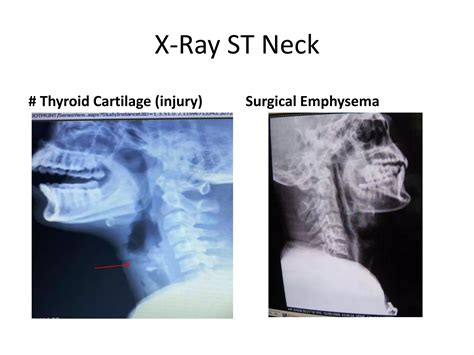 X Ray Soft Tissue Neck Valuable Economic Tool Ppt