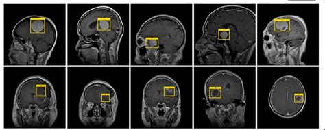 Brain Tumor Localization And Detection From Mri Images Using Yolov8 By Parisa Karimi Darabi