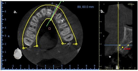 Prosthesis Free Full Text Analysis Of Cbct Bone Density Using The