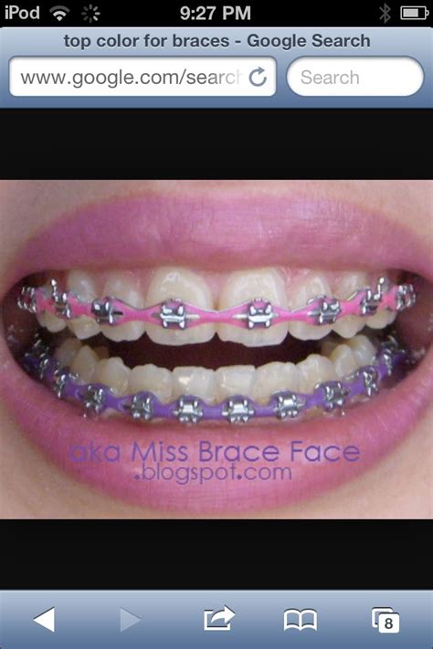 Good Colors For Braces Braces Colors Brace Face Braces Tips