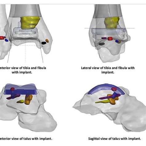 Pdf Bone Cysts And Osteolysis In Ankle Replacement